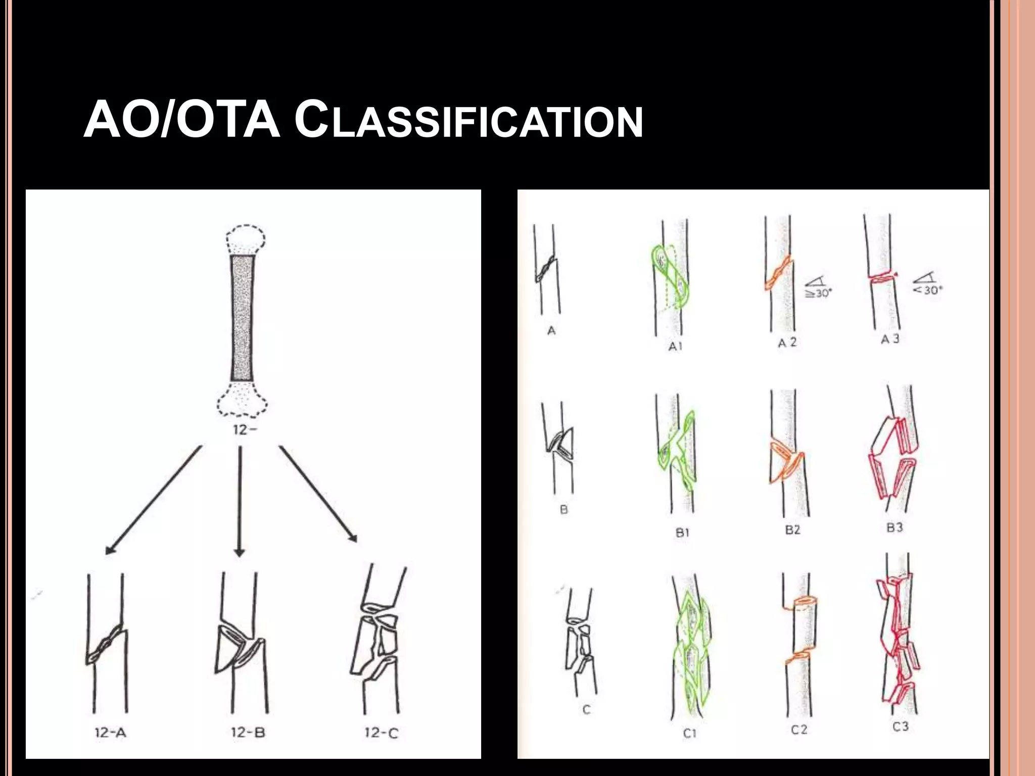 Proximal humerus fractures | PPTX