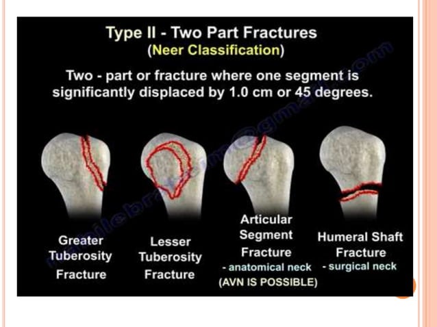 Proximal humerus fractures | PPTX