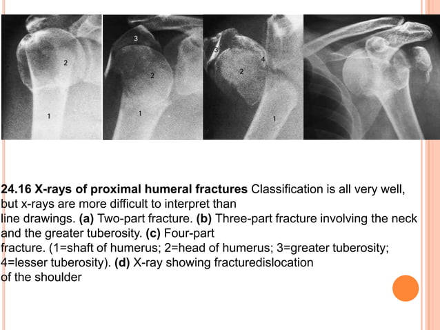 Proximal humerus fractures | PPTX