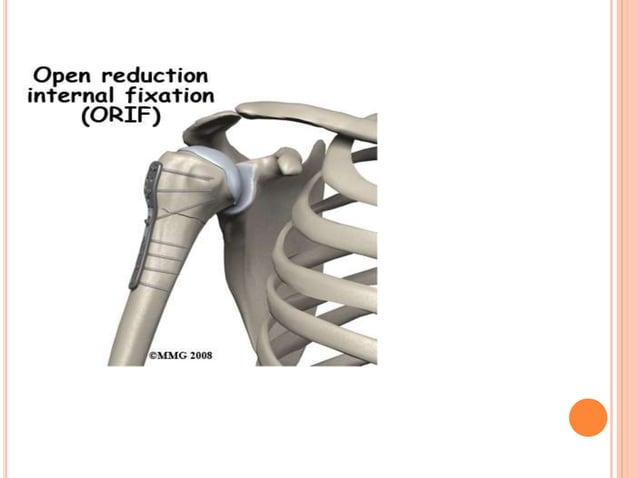 Proximal humerus fractures | PPTX