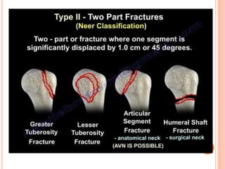 Proximal Humeral Fracture Classification