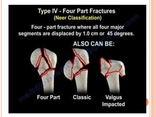 Four Part Proximal Humerus Fracture