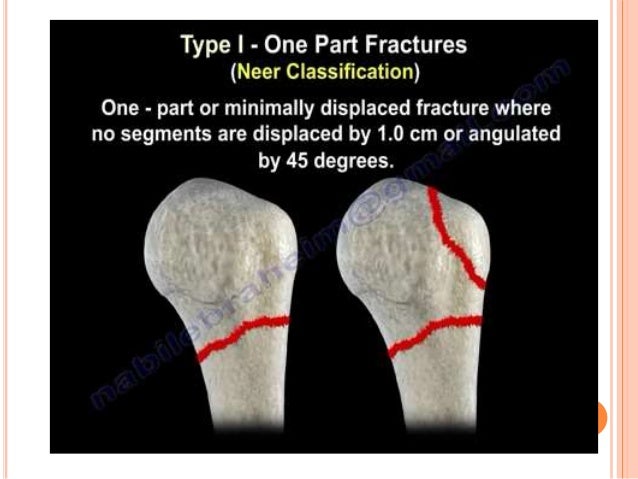 Proximal humerus fractures