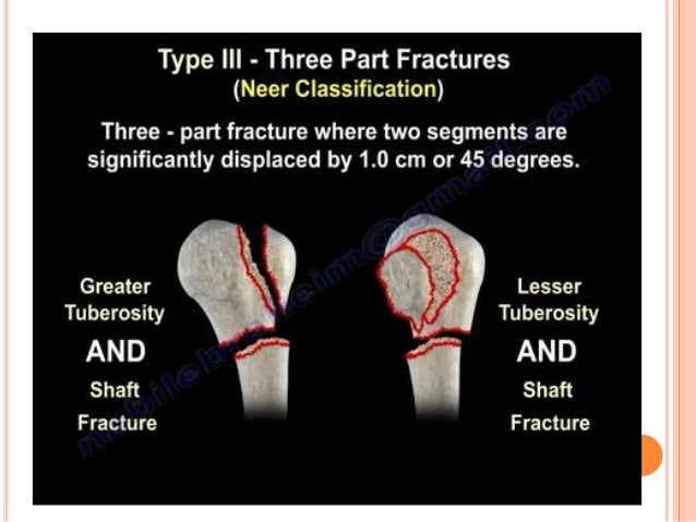 Proximal humerus fractures