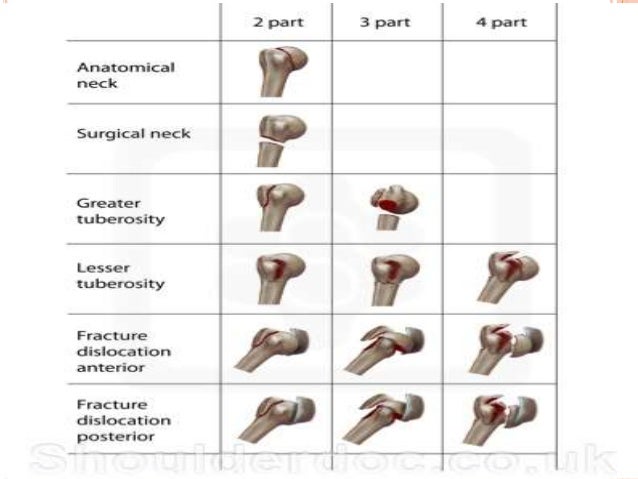 Proximal humerus fractures