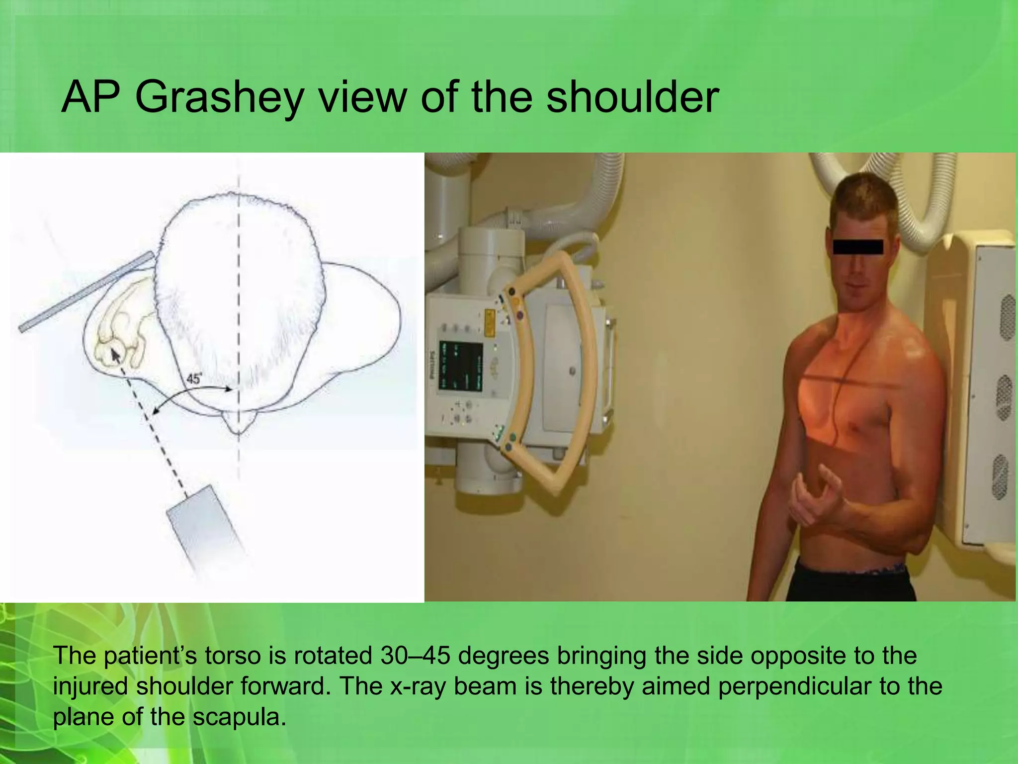 Proximal humerus fractures | PPTX