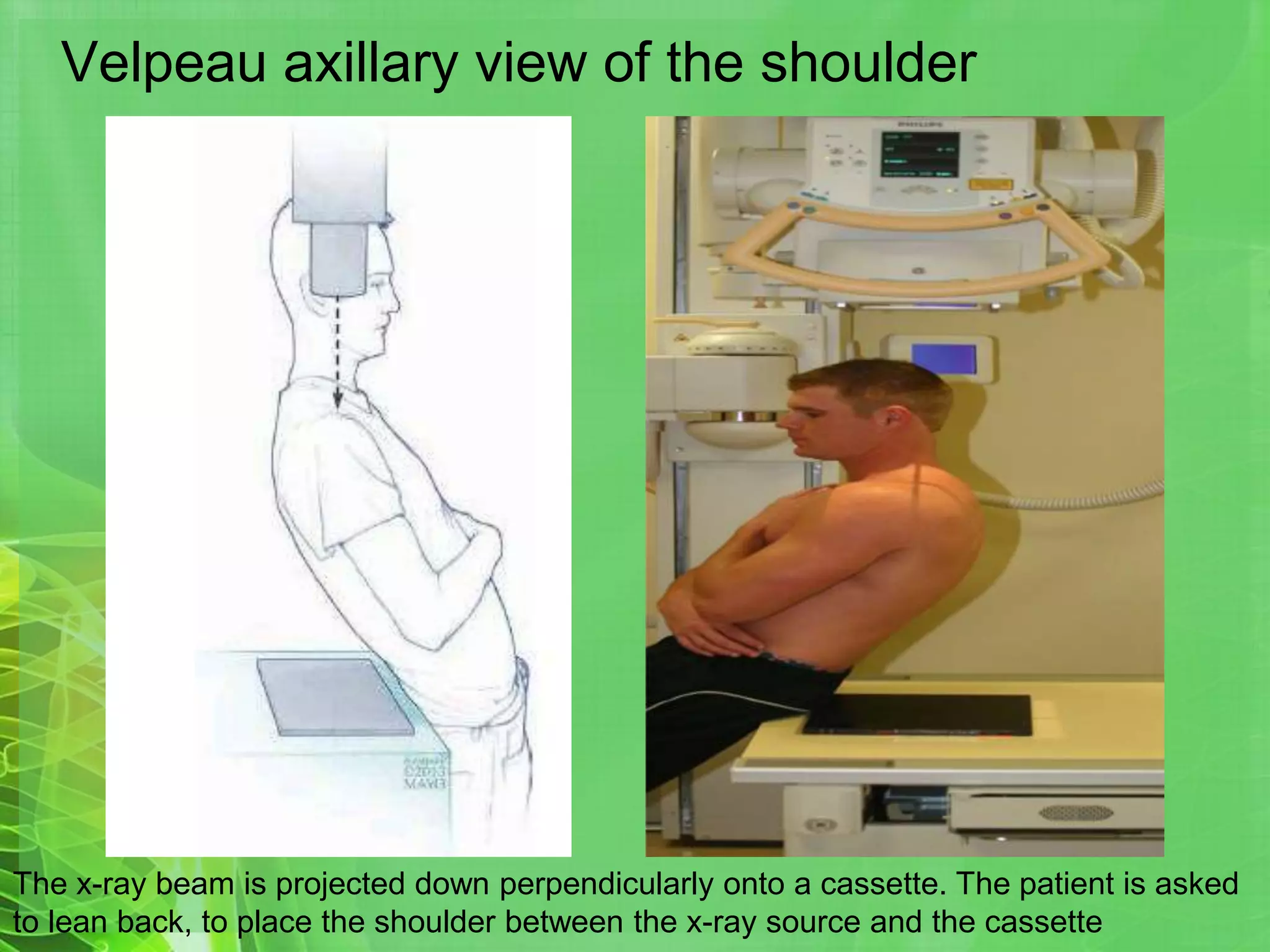 Proximal humerus fractures | PPTX
