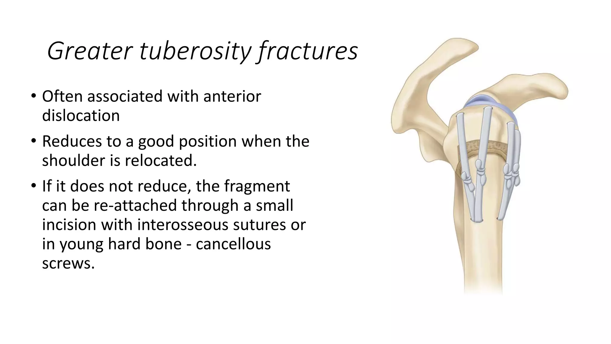 Proximal humerus fractures | PPTX