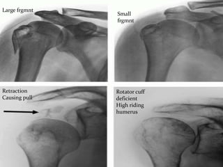 Proximal humerus fractures anatomy and classification | PPTX