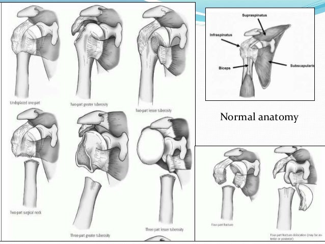 Proximal humerus fractures anatomy and classification