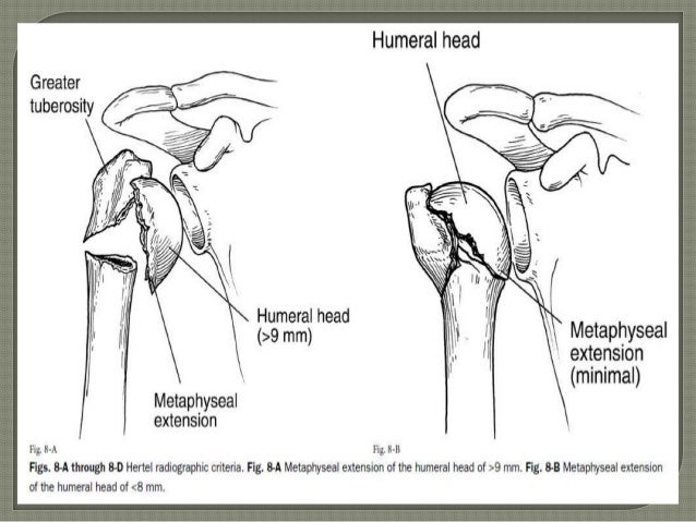 Proximal humerus fractures by krr