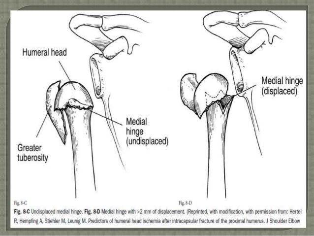 Proximal humerus fractures by krr