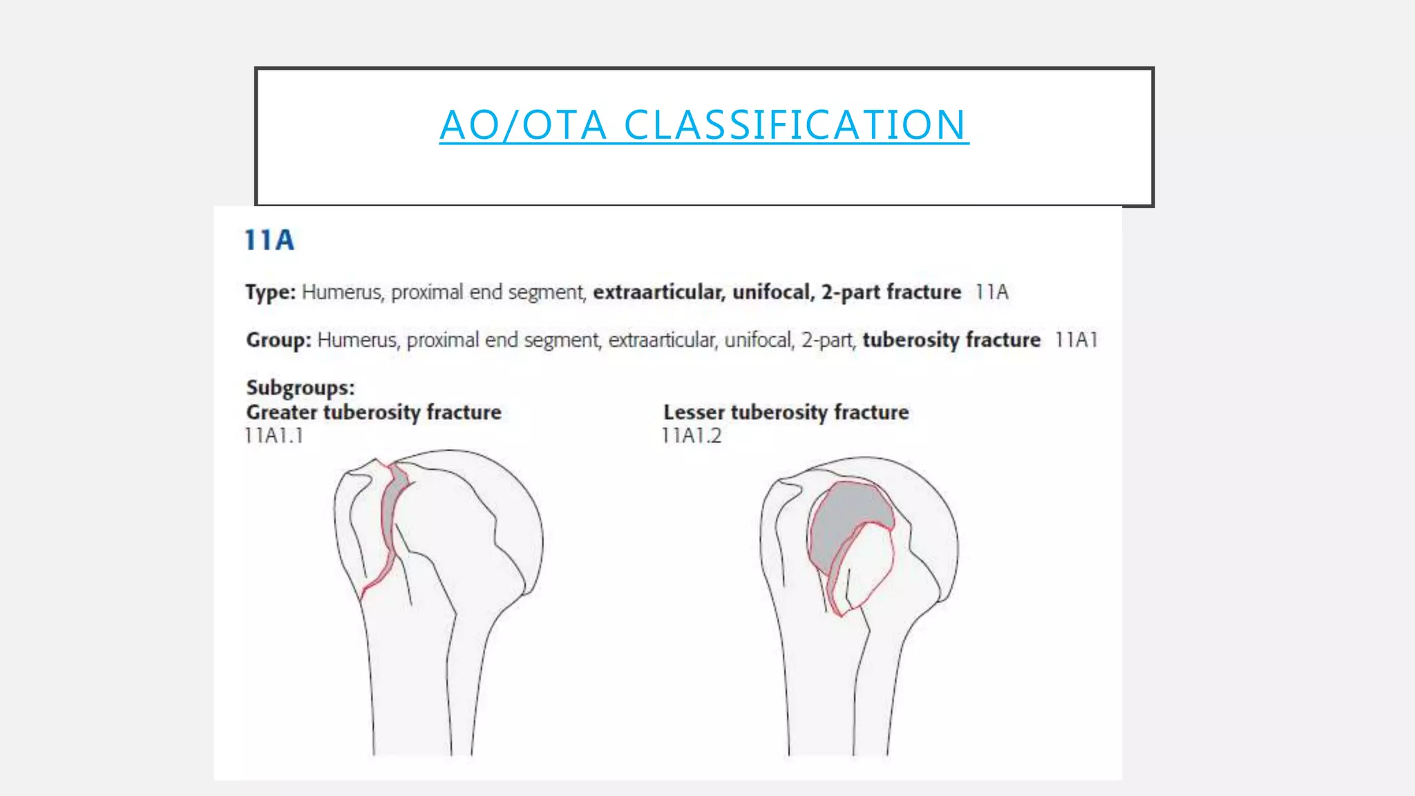 Proximal humerus fractures | PPTX