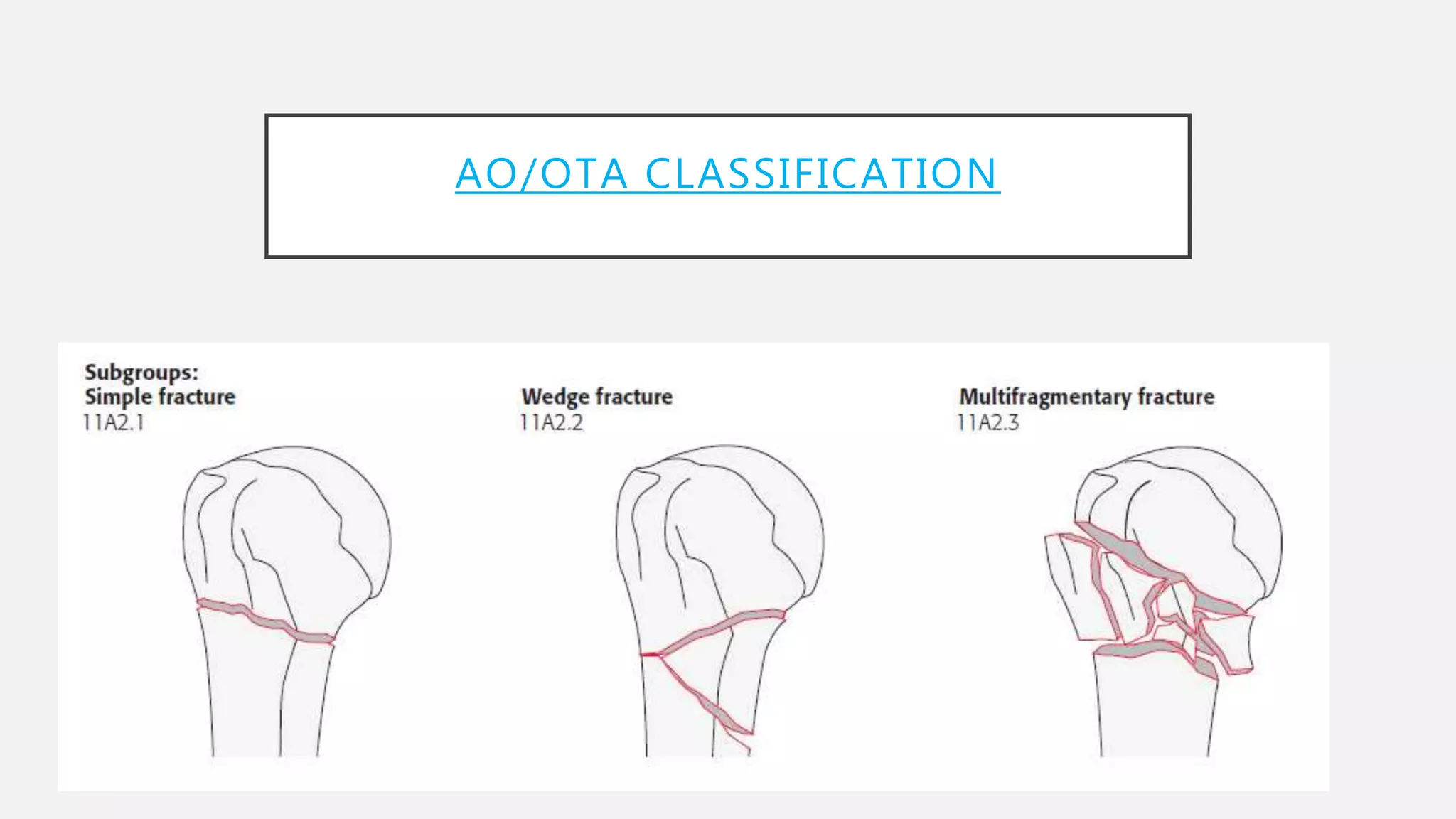 Proximal humerus fractures | PPTX