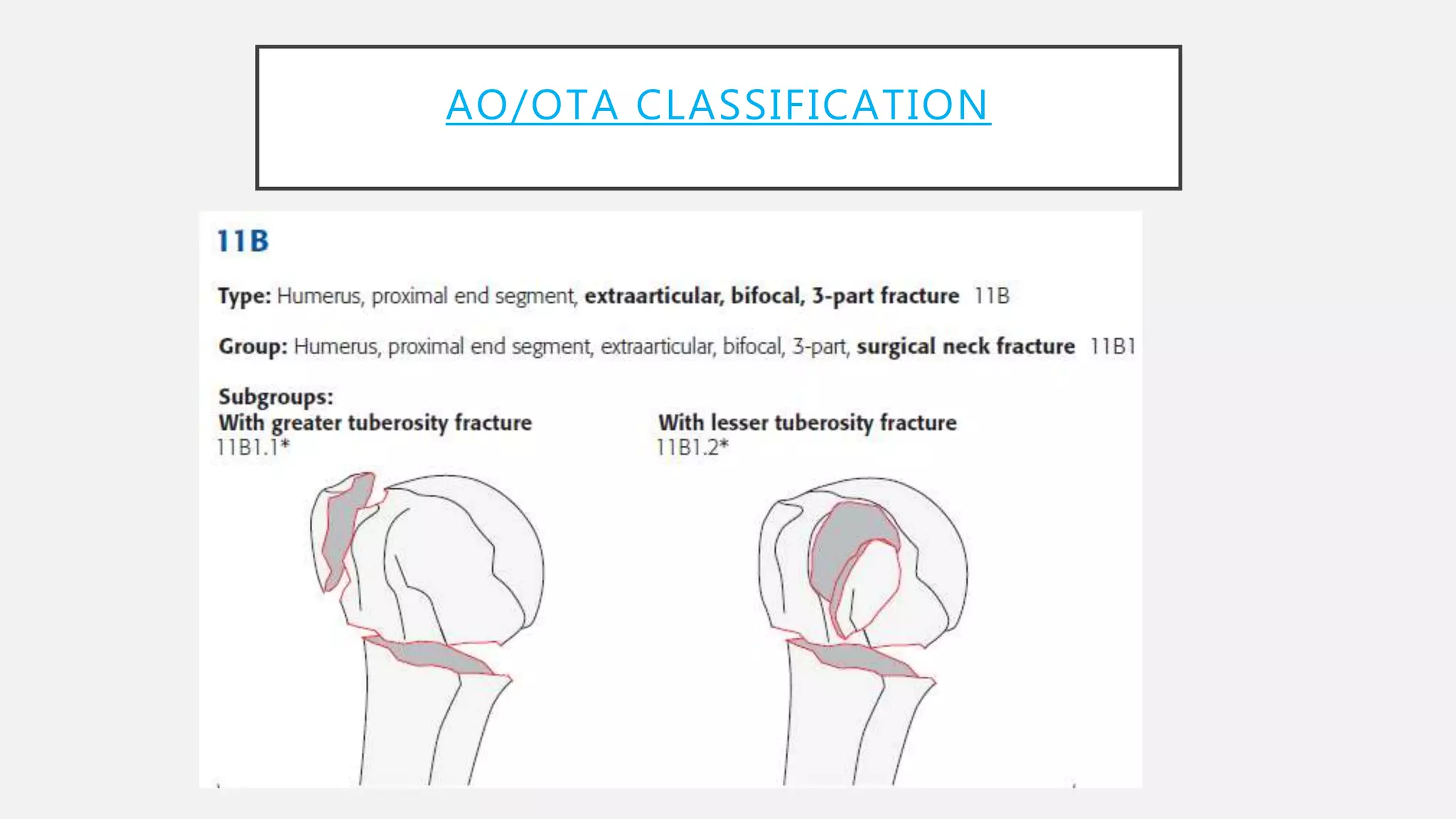 Proximal humerus fractures | PPTX