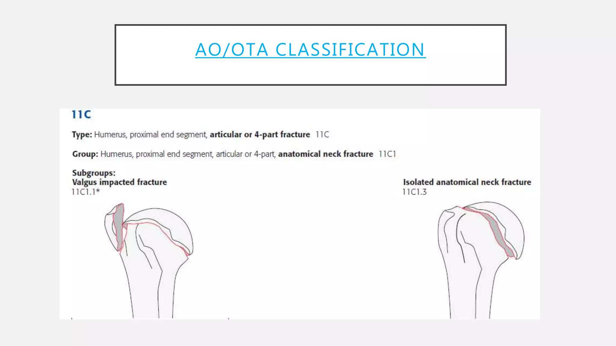 Proximal humerus fractures | PPTX