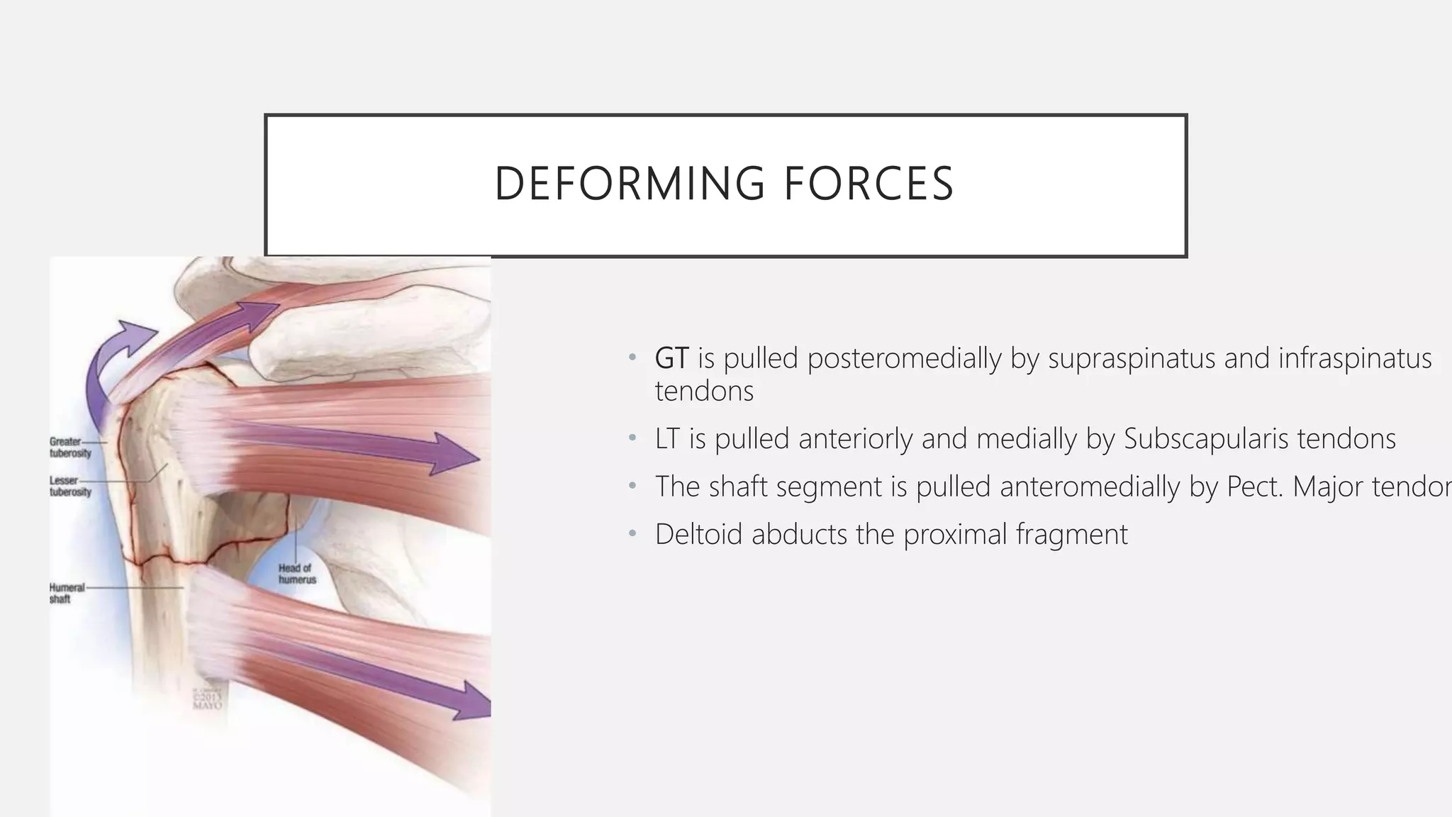 Proximal humerus fractures | PPTX