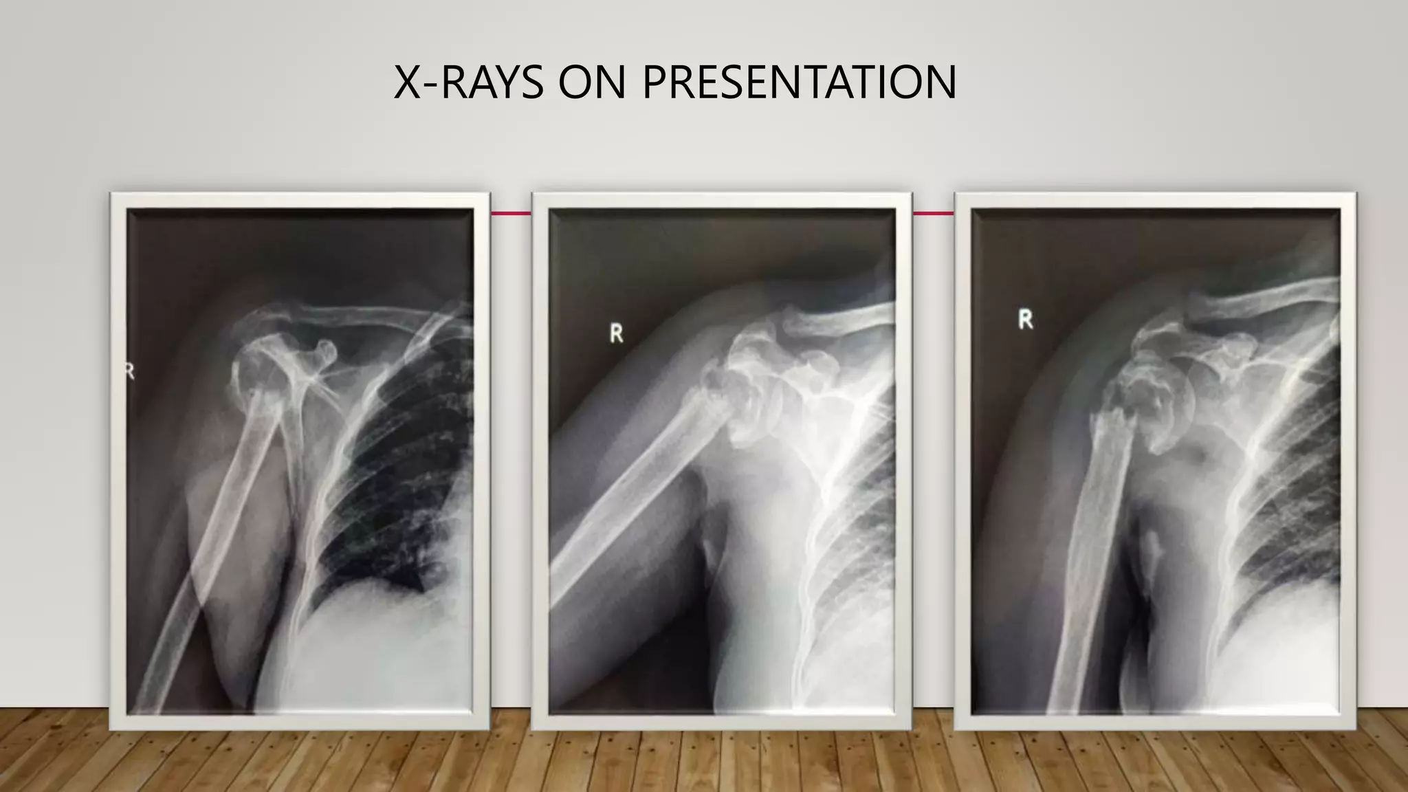 Proximal Humerus Non- Union.pptx