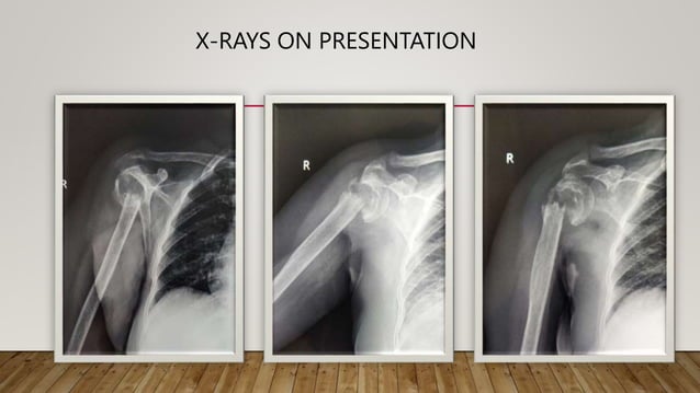 Proximal Humerus Non- Union.pptx