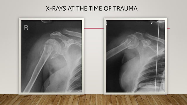 Proximal Humerus Non- Union.pptx