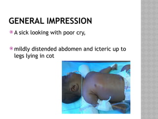 PROXIMAL JEJUNAL ATRESIA Dr Sajid Noor.pptx
