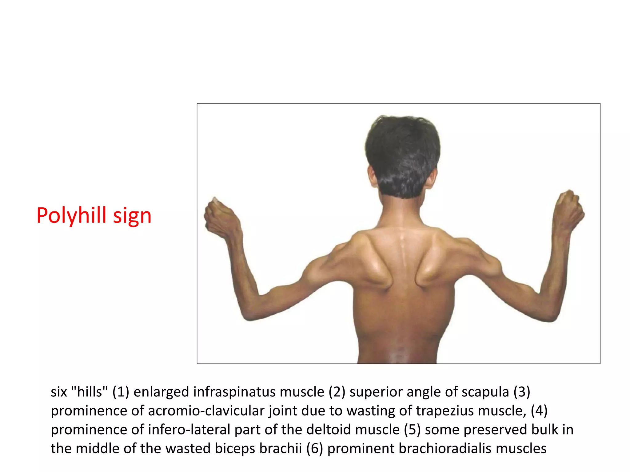 Proximal limb girdle syndromes approach | PPTX
