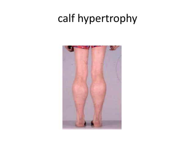 Proximal limb girdle syndromes approach | PPT