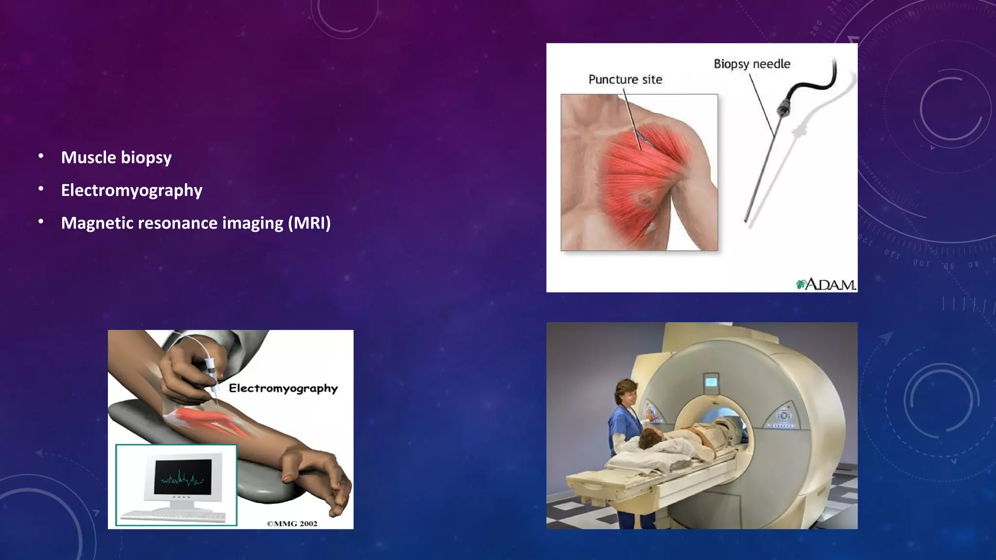 Proximal myopathy and causes | PPT