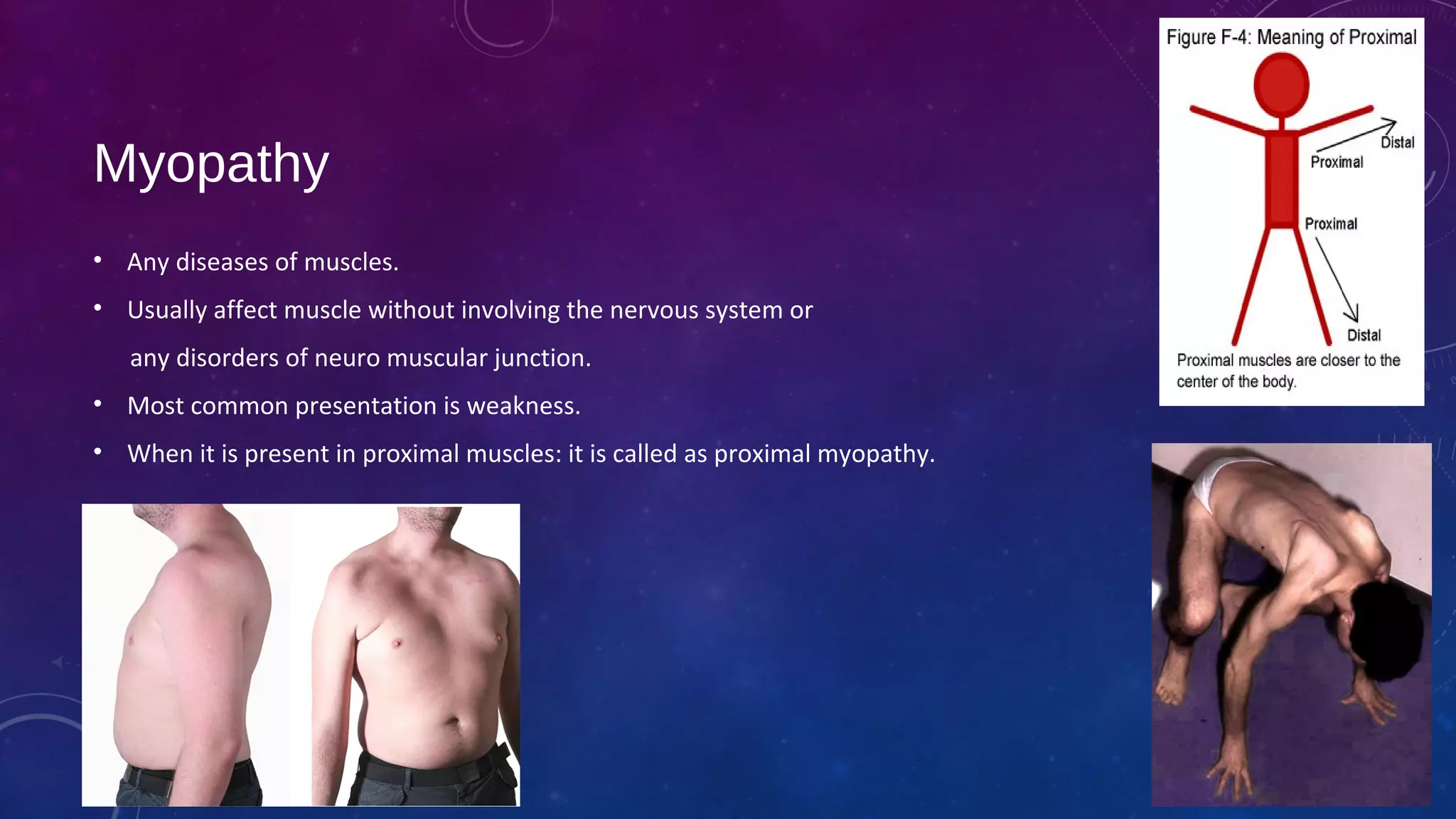 Proximal myopathy and causes | PPT