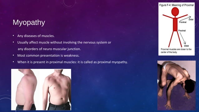Proximal myopathy and causes | PPT