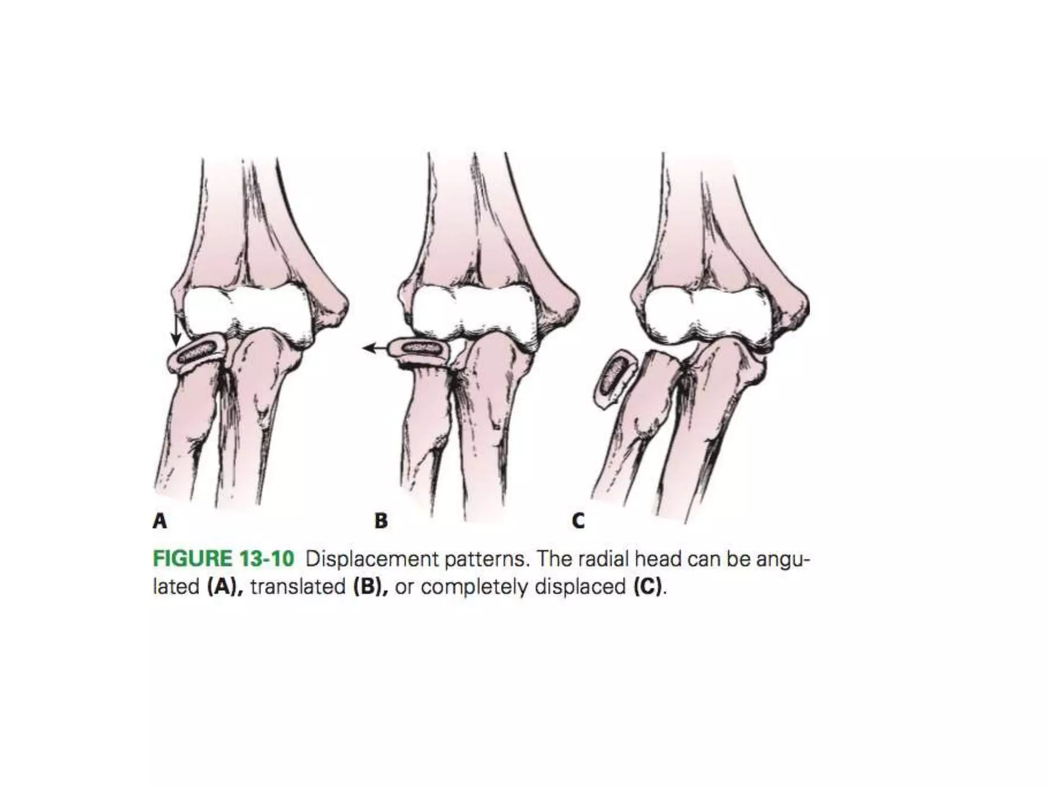 Proximal radius fractures in children | PPTX