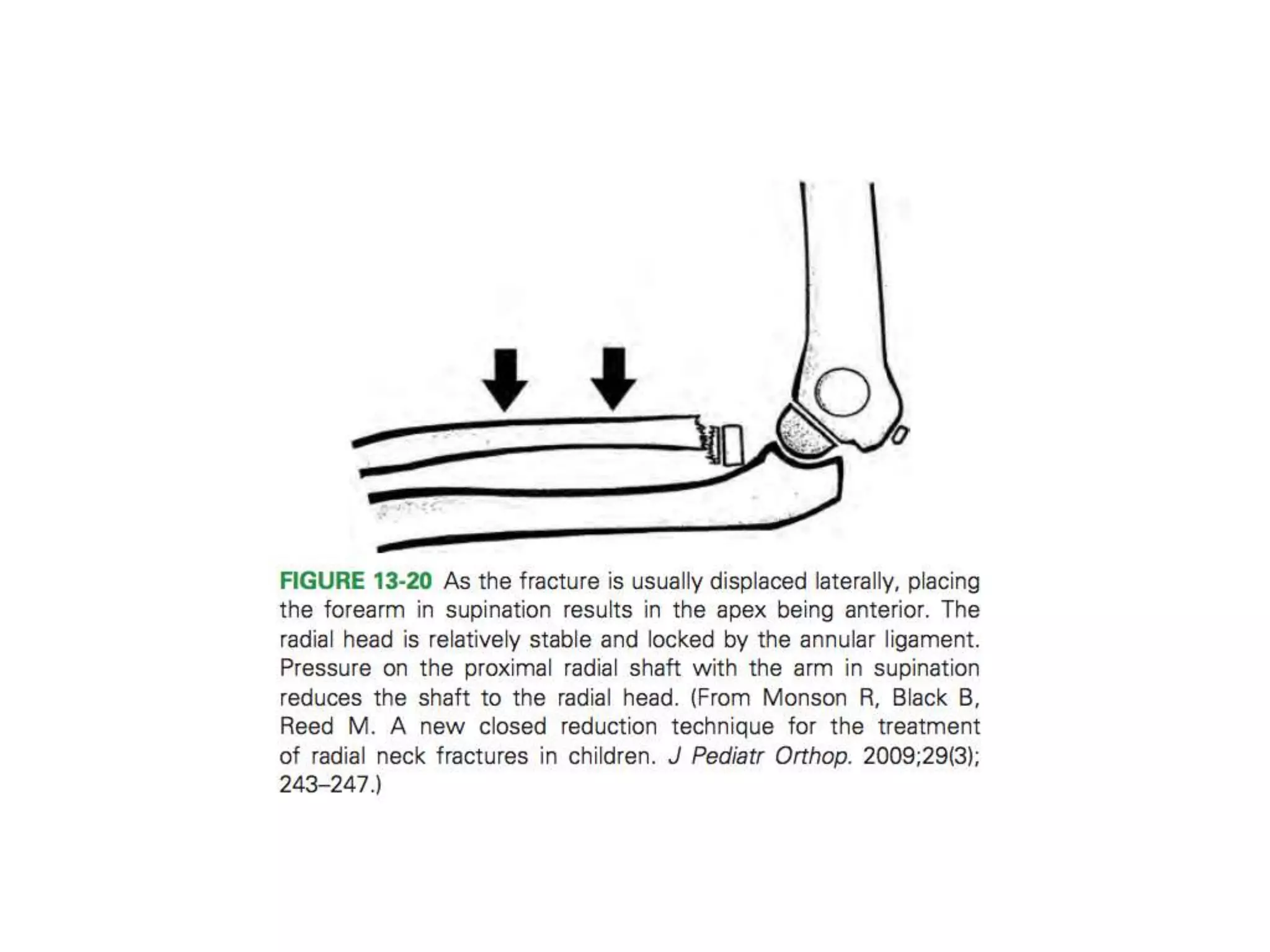 Proximal radius fractures in children | PPTX