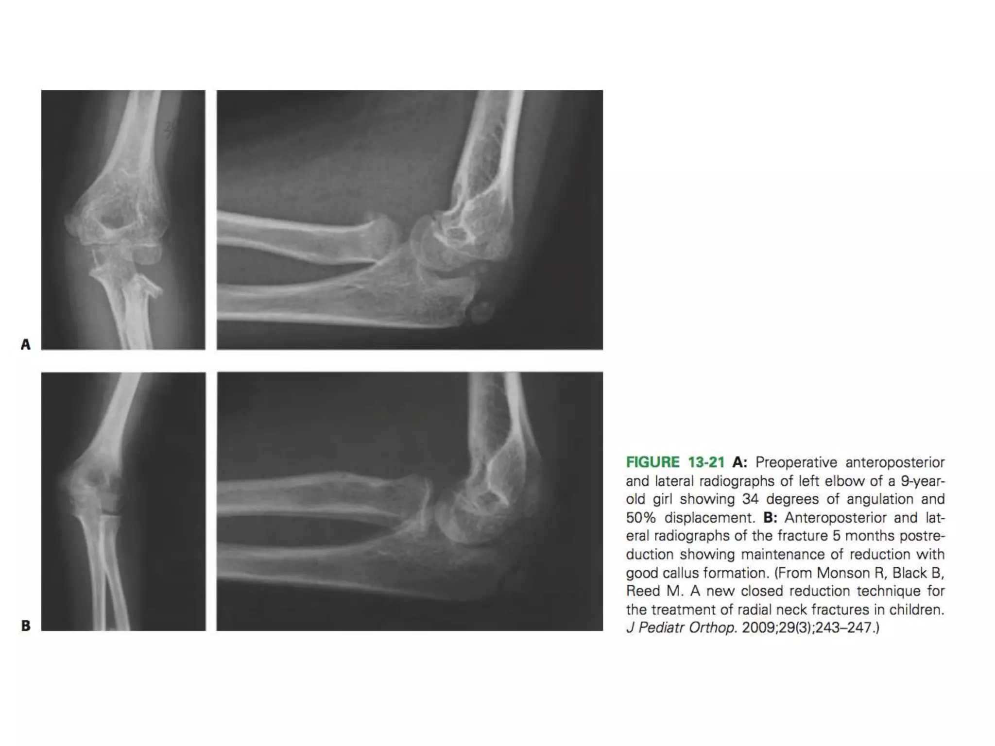 Proximal radius fractures in children | PPTX
