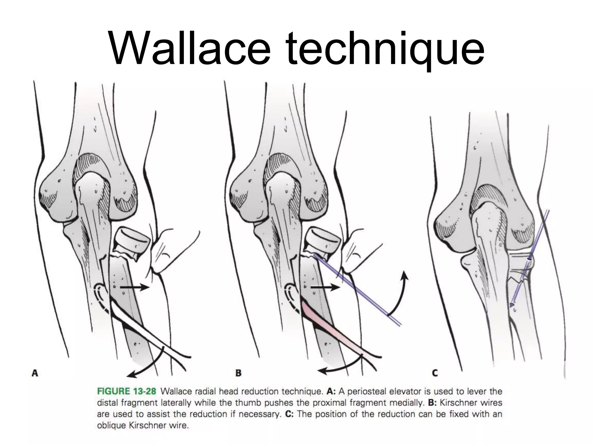 Proximal radius fractures in children | PPTX