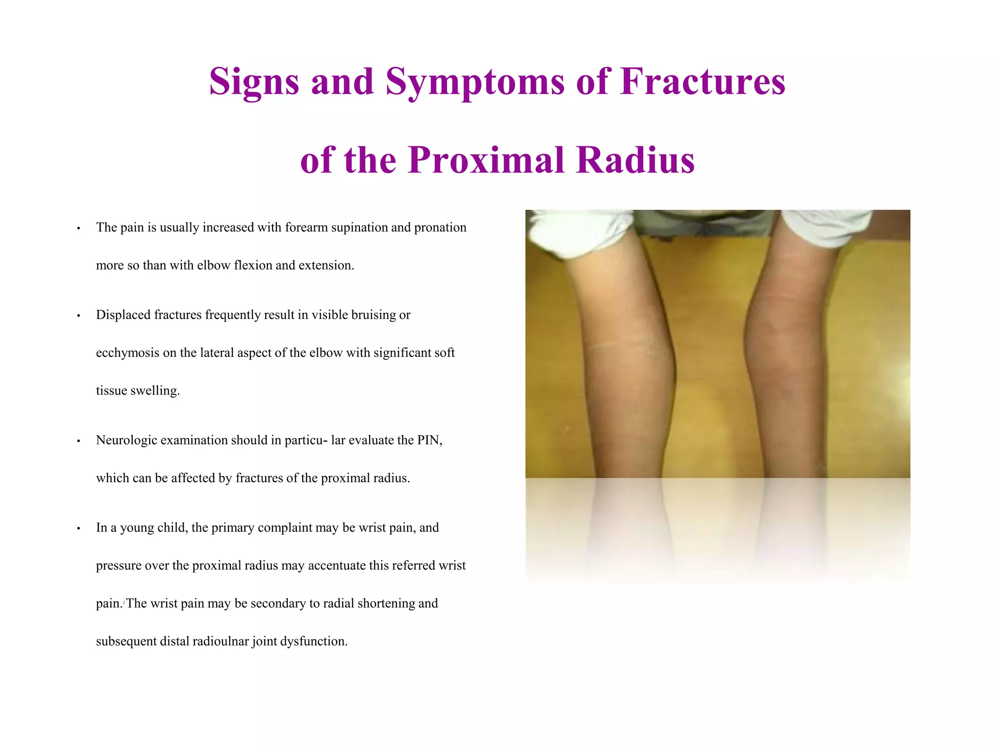 Proximal radius fractures in children | PPTX
