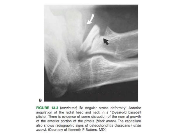 Proximal radius fractures in children | PPT