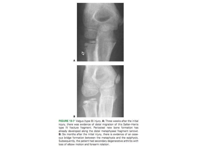 Proximal radius fractures in children | PPT