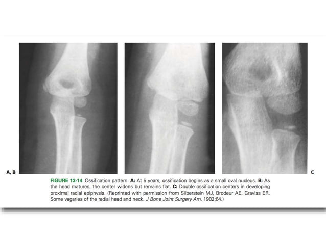 Proximal radius fractures in children | PPT