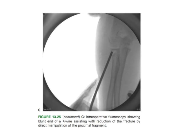 Proximal radius fractures in children | PPT