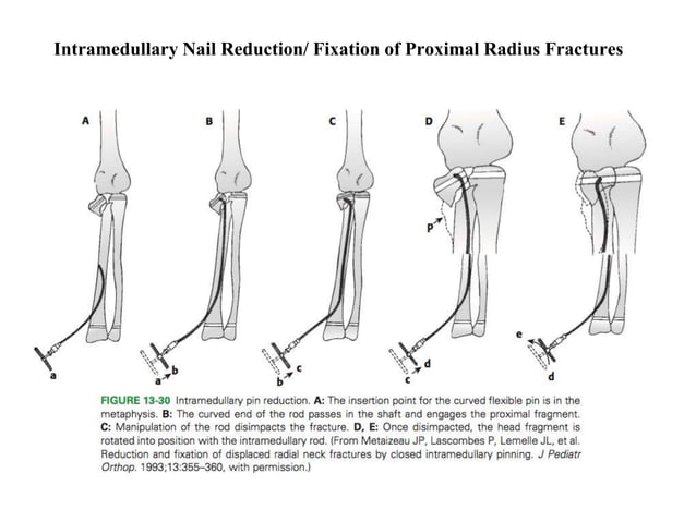 Proximal radius fractures in children | PPT