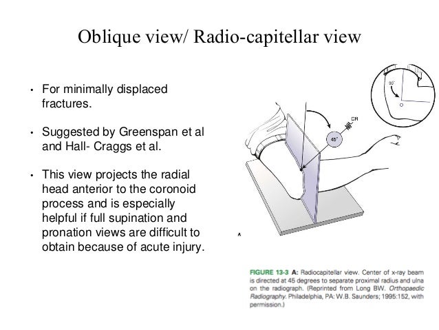 Proximal radius fractures in children