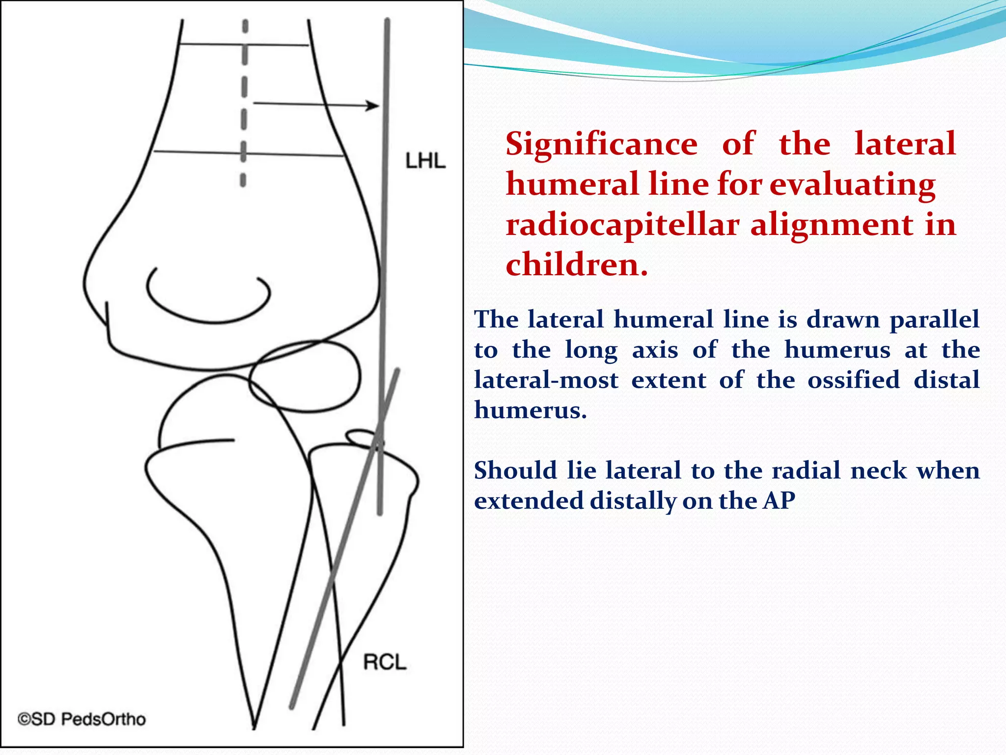 Proximal Radius Fractures in Children.pptx
