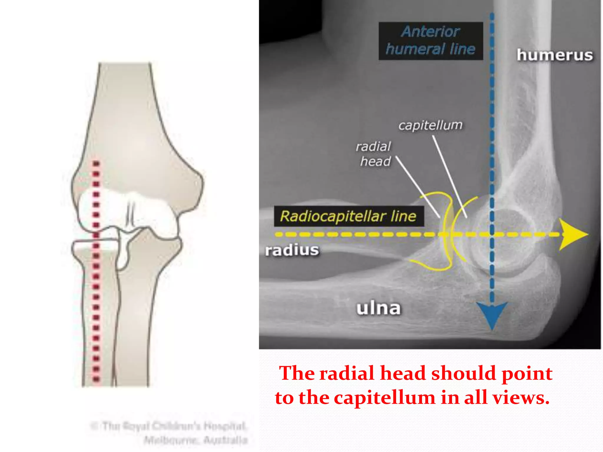 Proximal Radius Fractures in Children.pptx
