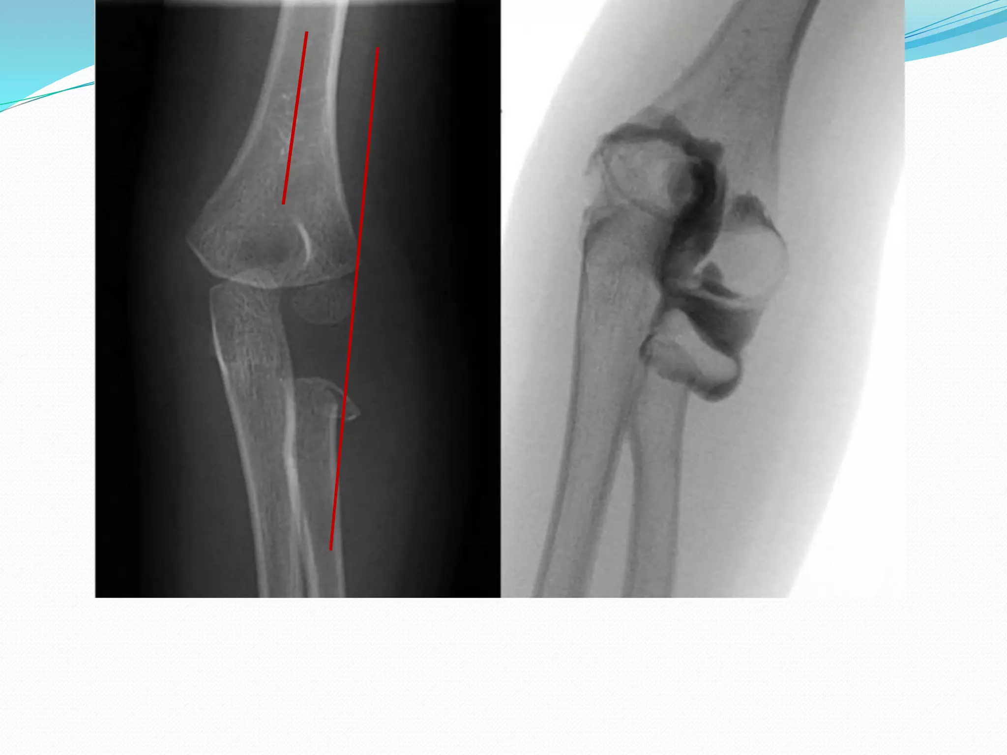 Proximal Radius Fractures in Children.pptx