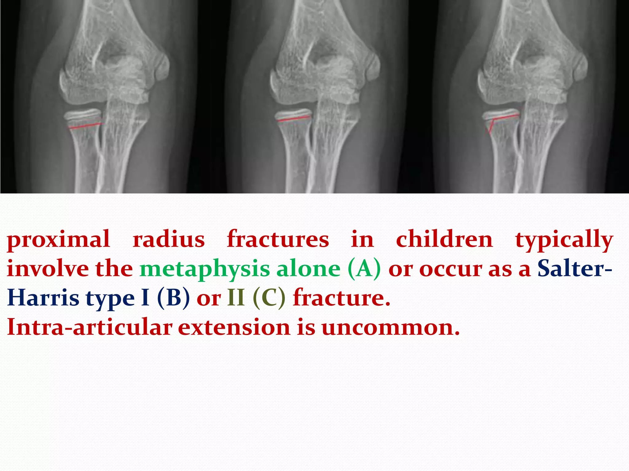 Proximal Radius Fractures in Children.pptx