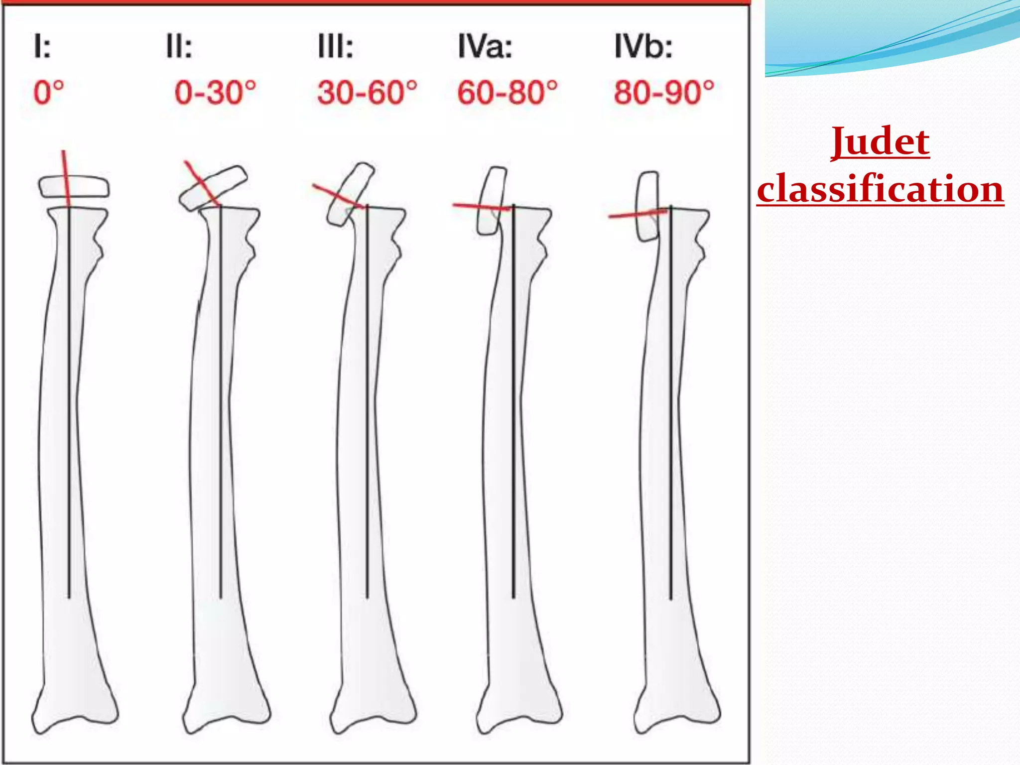 Proximal Radius Fractures in Children.pptx