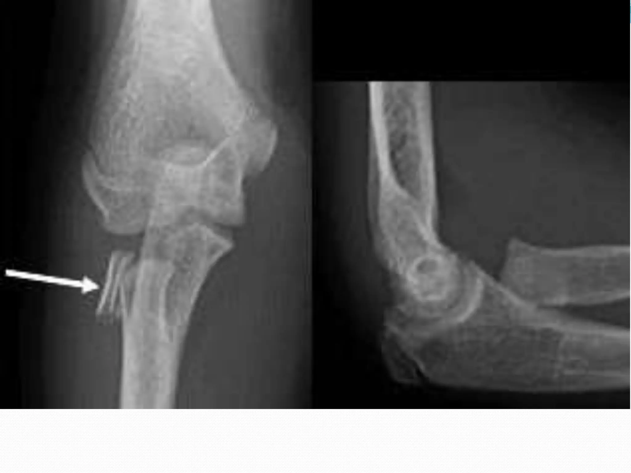 Proximal Radius Fractures in Children.pptx