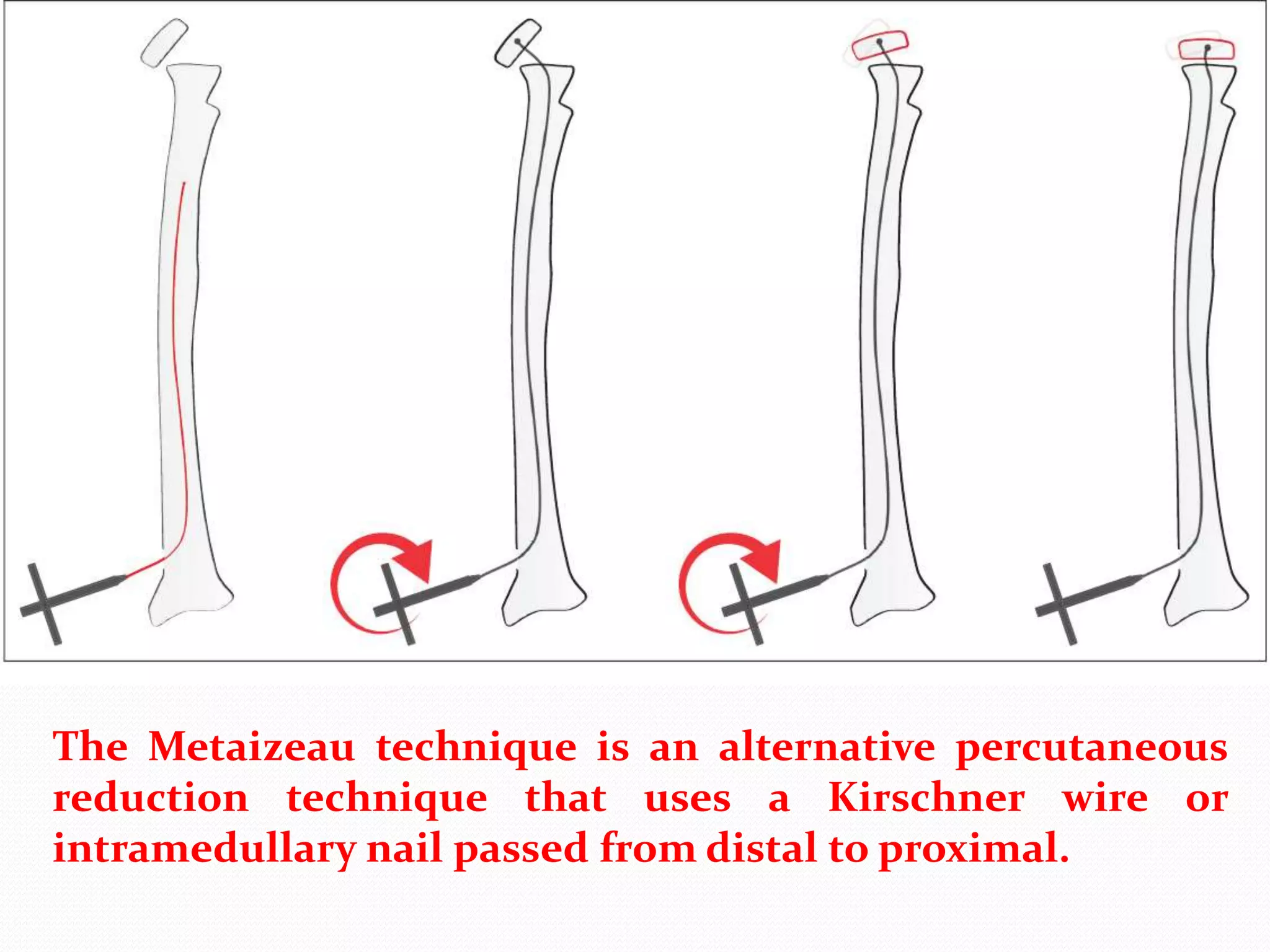 Proximal Radius Fractures in Children.pptx