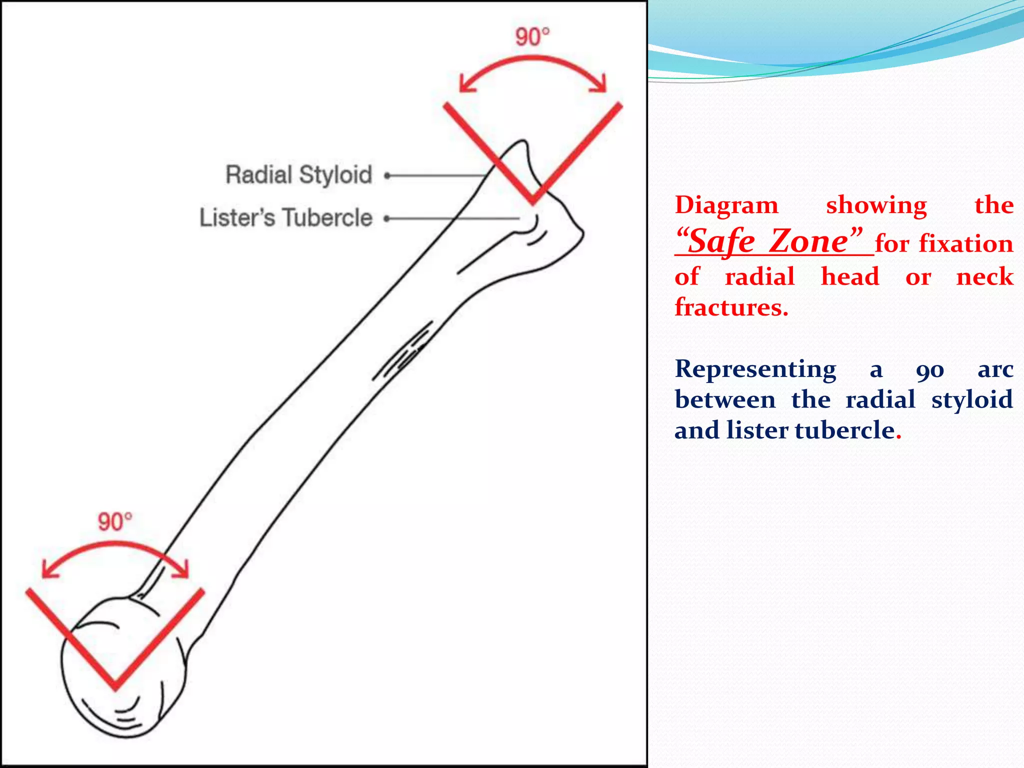 Proximal Radius Fractures in Children.pptx