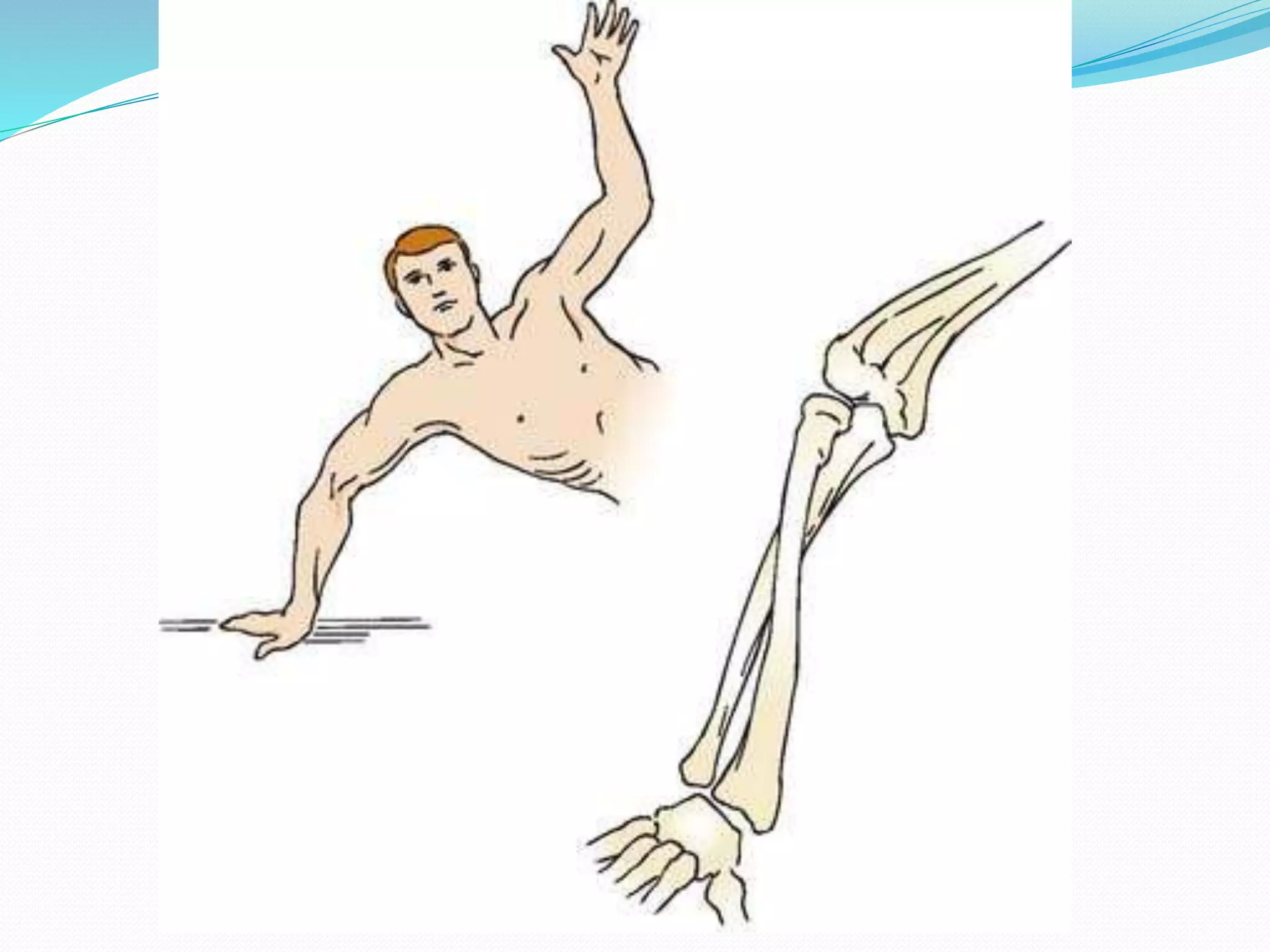 Proximal Radius Fractures in Children.pptx